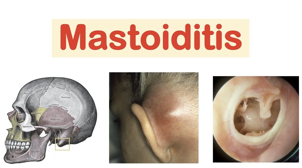 Mastoiditis (& Acute Otitis Media) | Causes, Pathophysiology, Symptoms ...