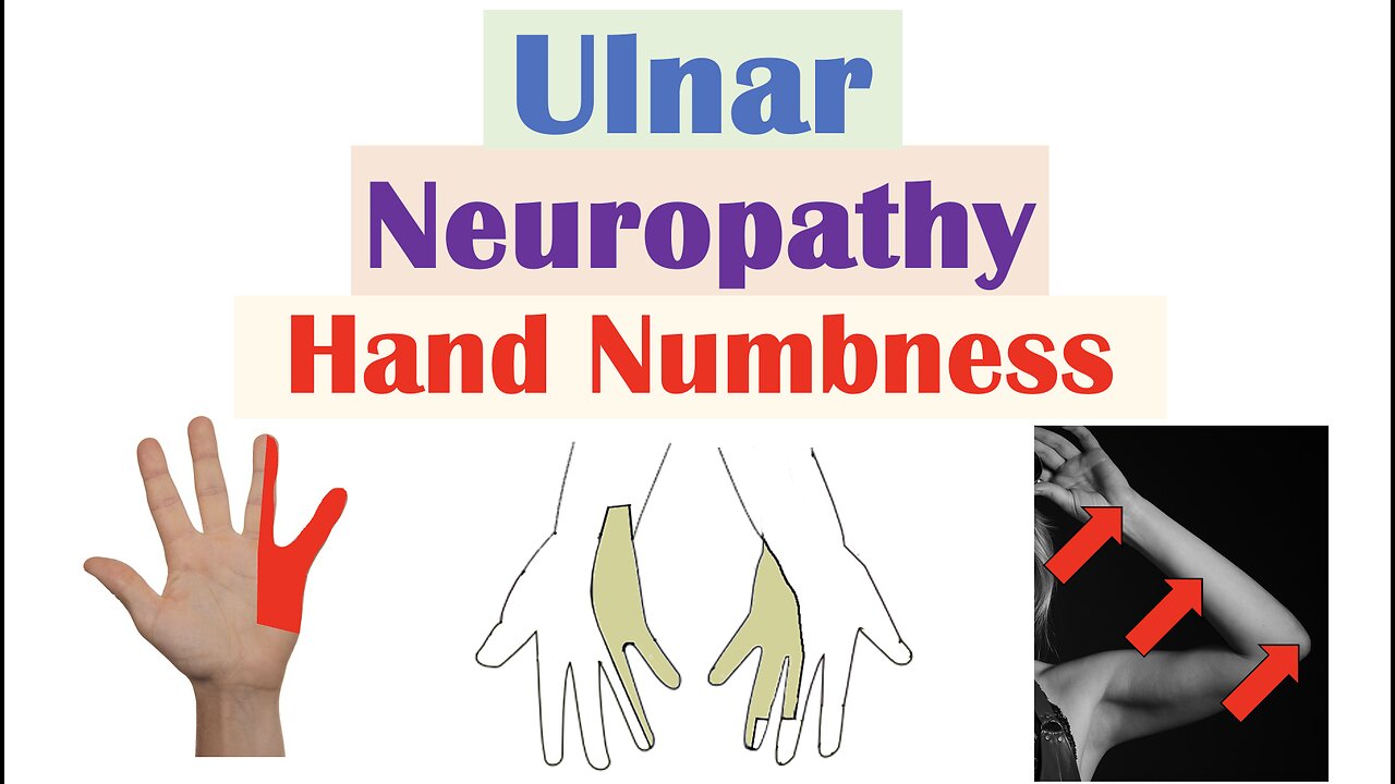 Ulnar Neuropathy (& Numbness in the Hand) | Causes, Signs & Symptoms ...