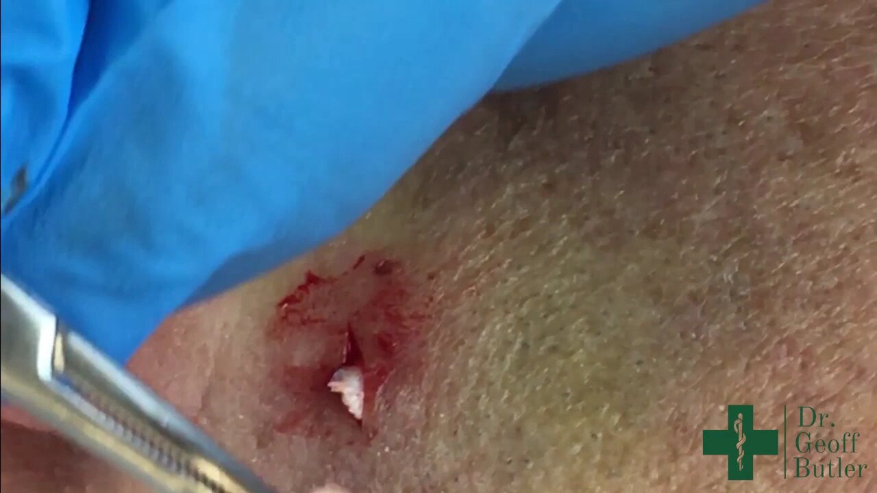 Removal of an Epidermal Cyst in the Preauricular Space