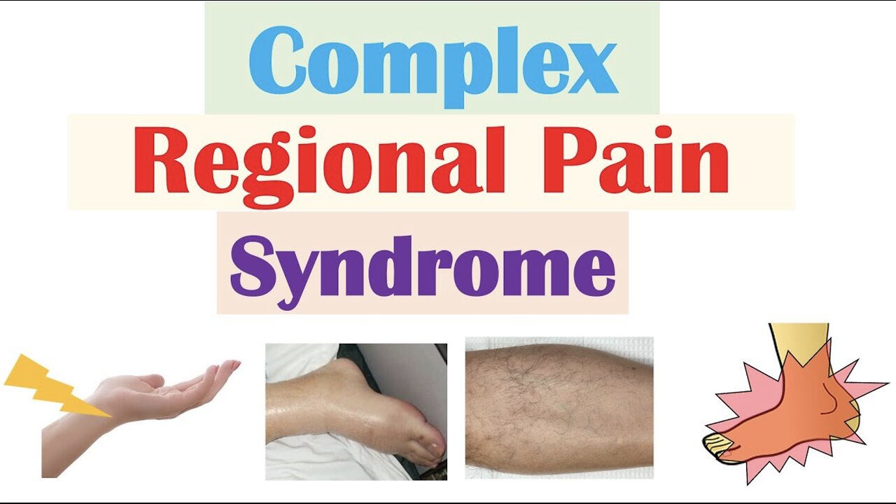 Complex Regional Pain Syndrome | Causes, Pathophysiology, Signs ...