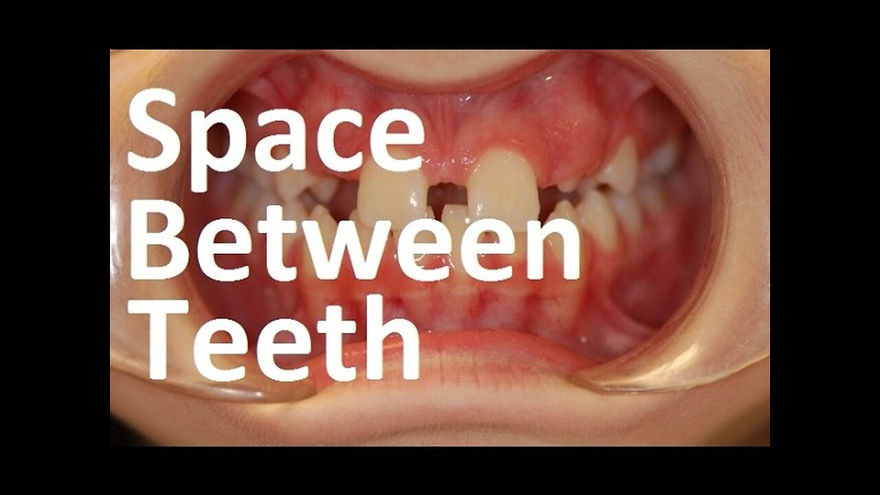 Causes & Orthotropics Treatment of Gaps Between Teeth (Diastema) by ...