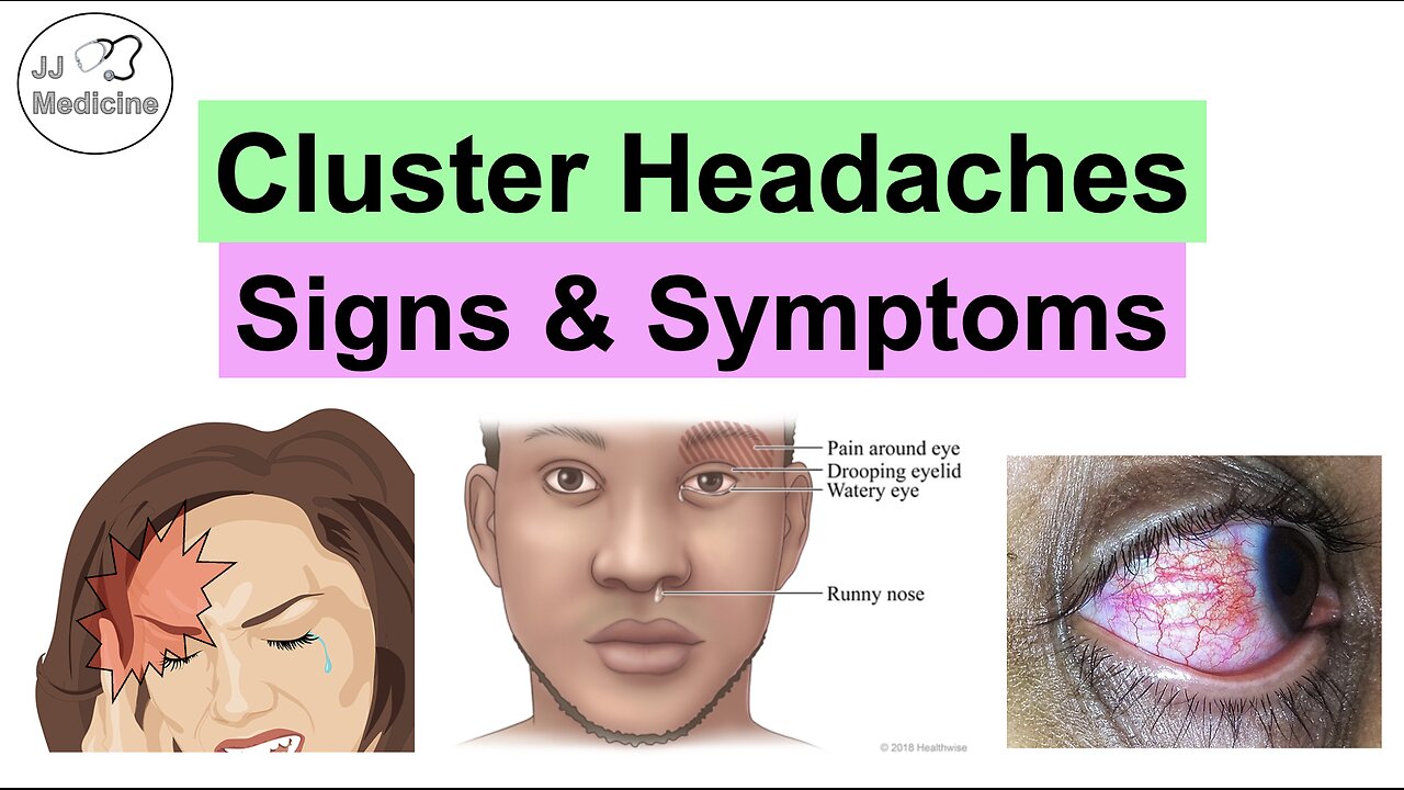 Cluster Headaches Symptoms, Associated Issues & Triggers