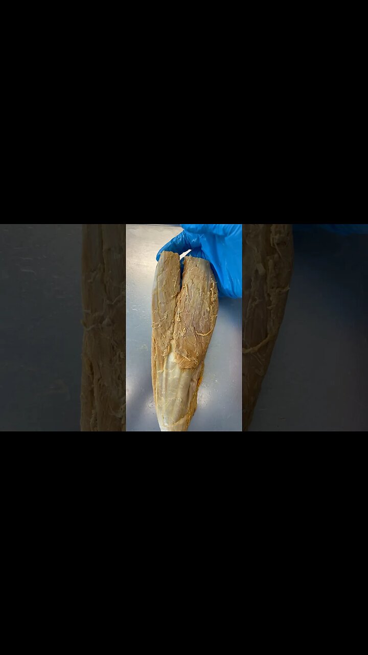 Real Human Calf Muscle That Looks Like a Fish!