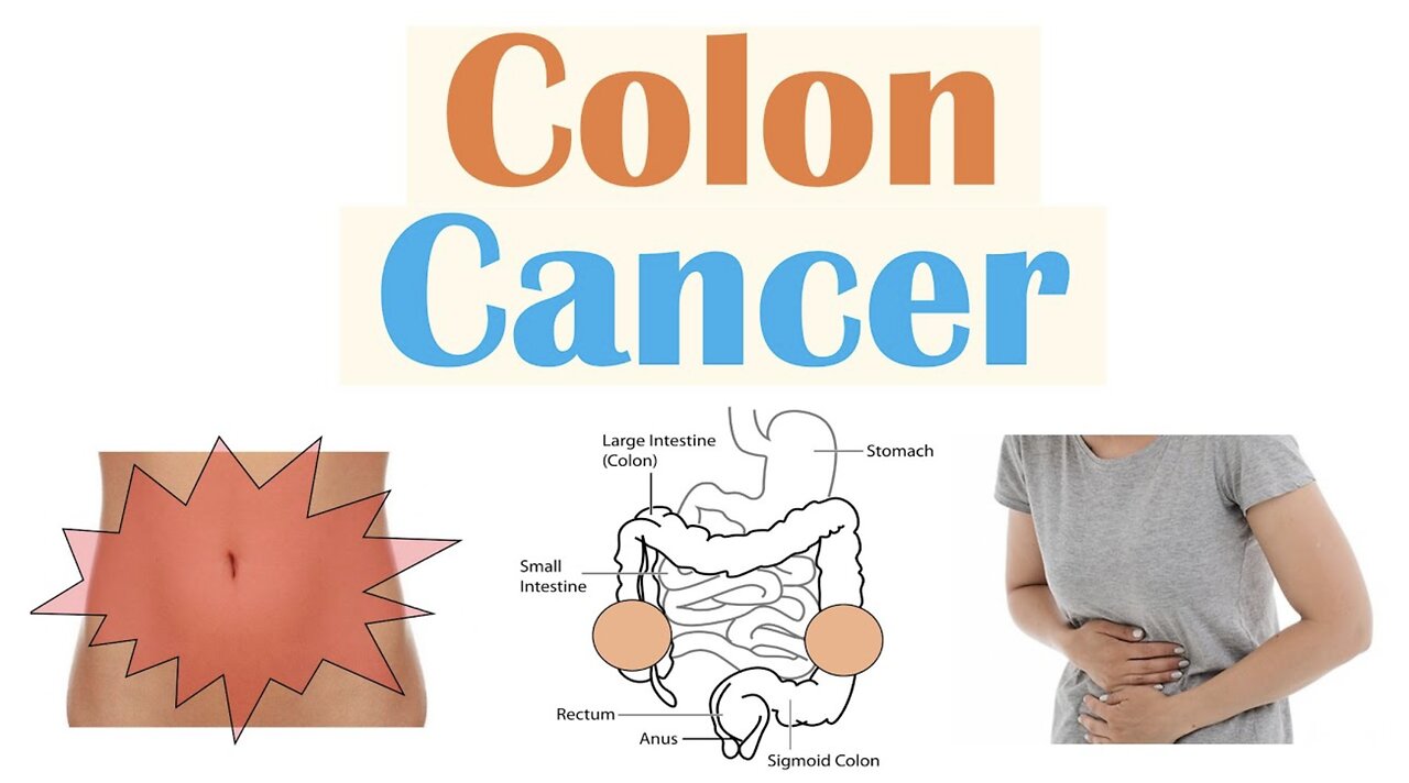 Colon Cancer (CRC) Risk Factors, Pathogenesis, Symptoms, Diagnosis ...