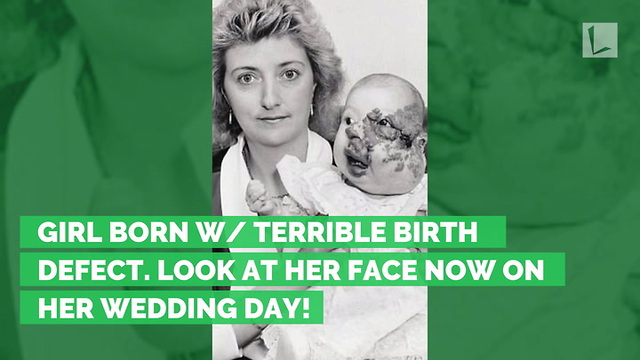 Girl Born w/ Terrible Birth Defect. Look at Her Face Now on Her Wedding ...