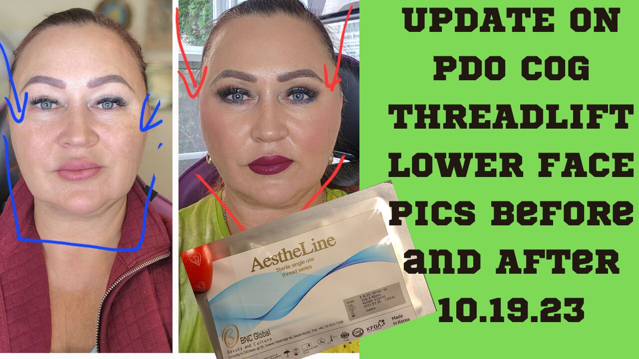 UPDATES PDO COGS THREADLIFT LOWER FACE BEFORE AND AFTER 10.19.23 # ...