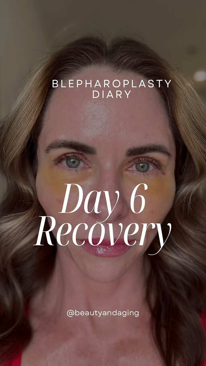 Day 6 Recovery | Eyelid Lift Surgery with Fat Transfer