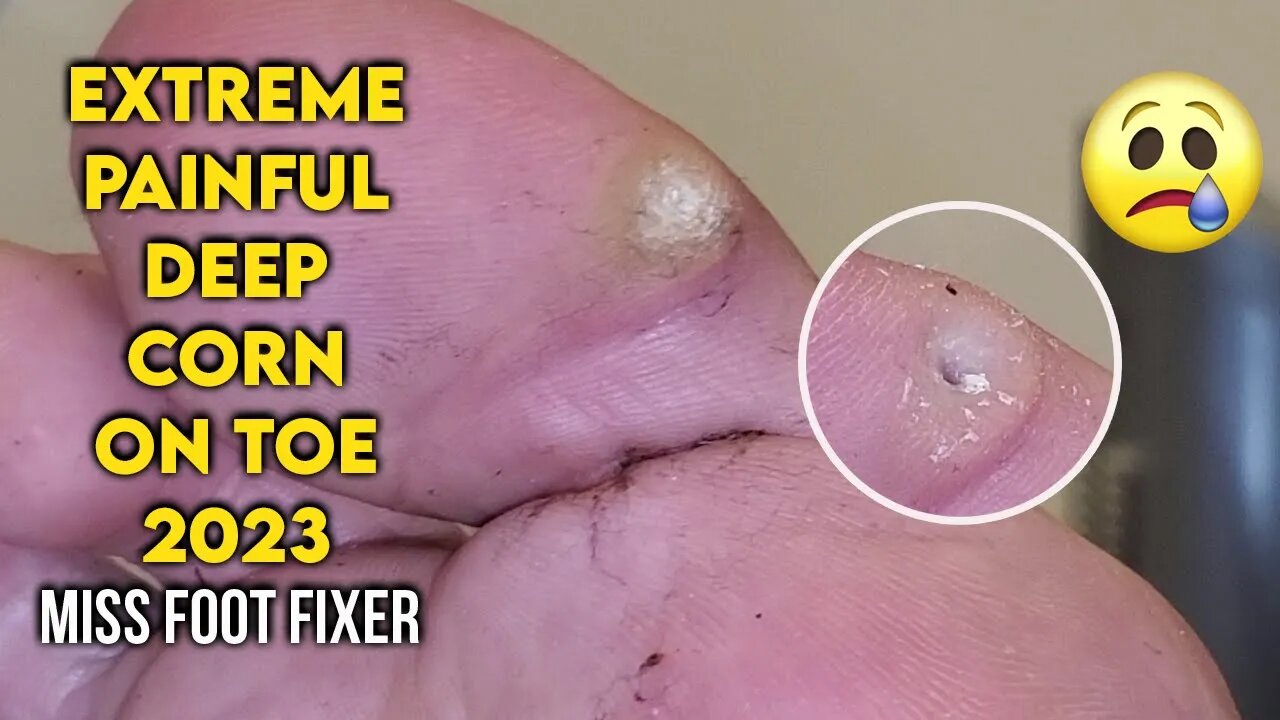 EXTREME PAINFUL DEEP CORN ON TOE 2023 PROPER TREATMENT BY FAMOUS ...