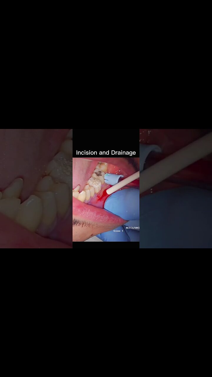 Incision And Drainage Abscess Draining Pus