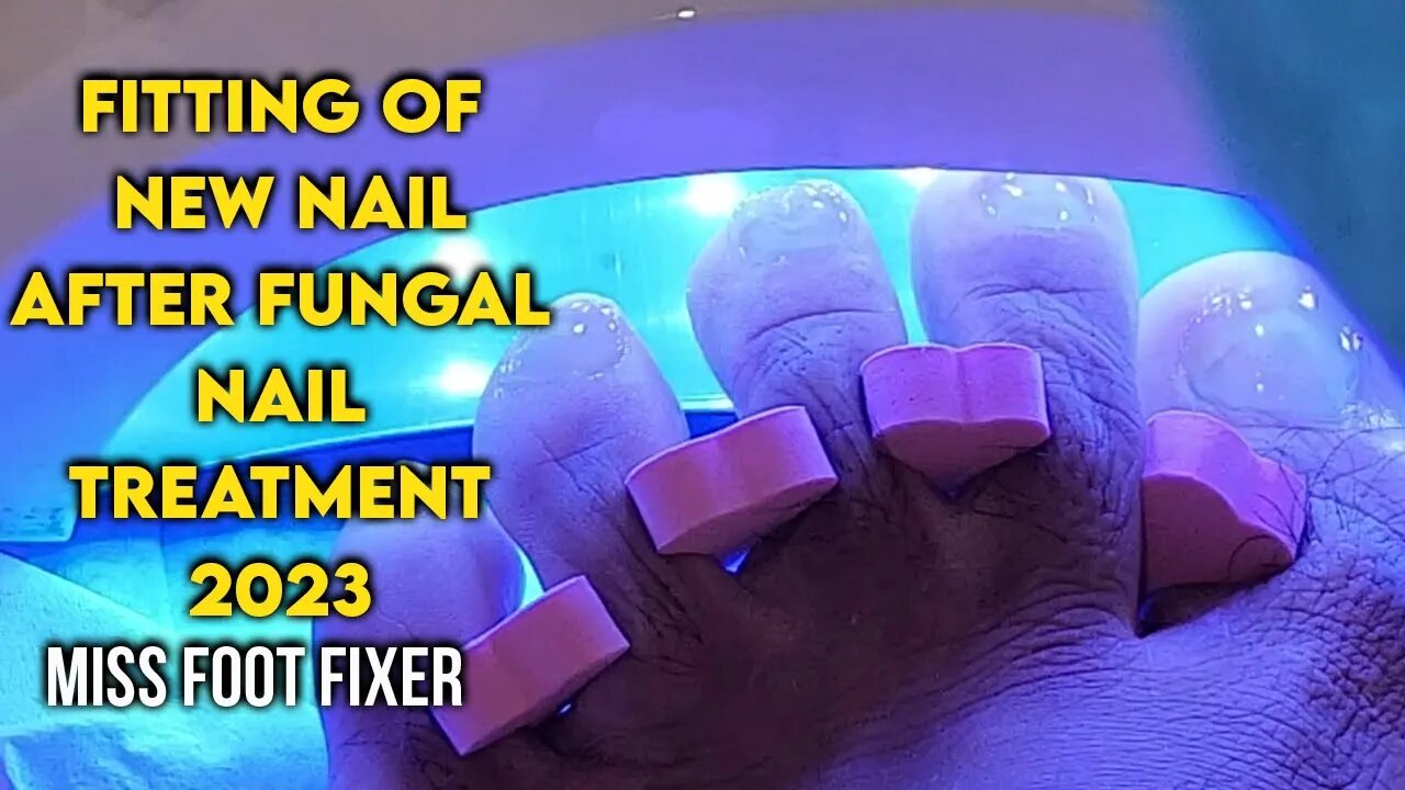 FITTING OF A NEW TOENAIL AFTER DOING FUNGAL NAIL TREATMENT BY FAMOUS ...