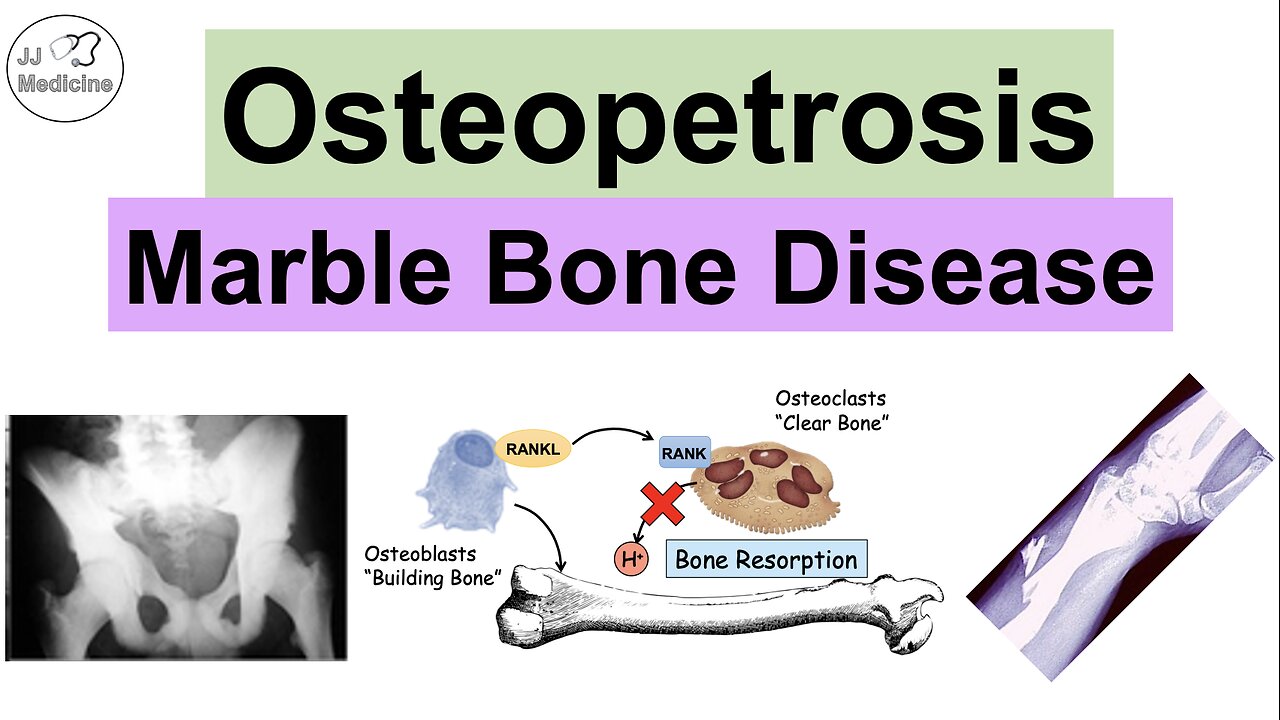 Osteopetrosis (Marble Bone Disease) | Causes, Symptoms, Diagnosis ...