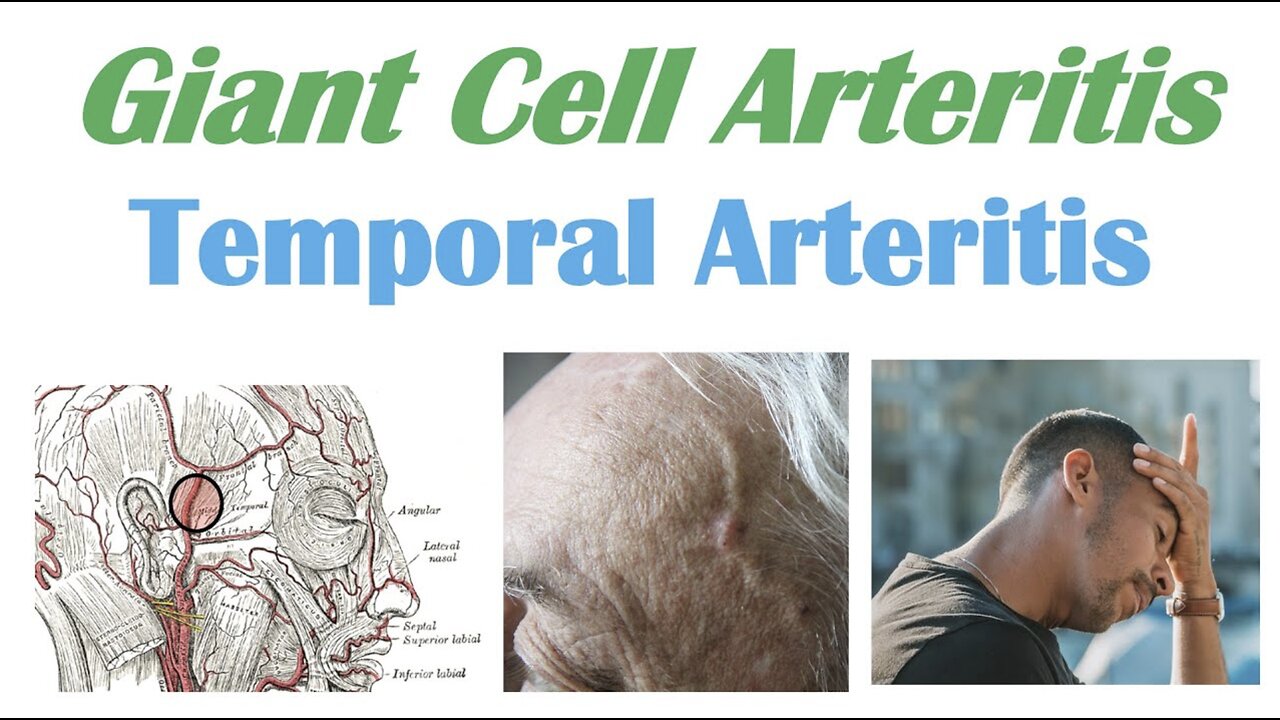 Giant Cell Arteritis (Temporal Arteritis) | Causes, Pathophysiology ...