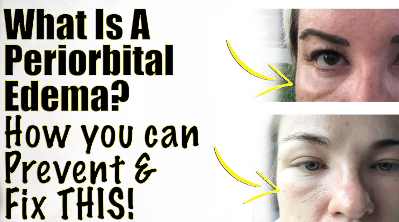 What Is A Periorbital Edema How You Can Prevent And Fix This Code Jessica10 Saves You Money