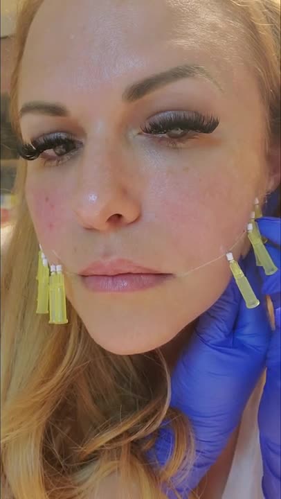 Cheeks PDO threads - June 2021