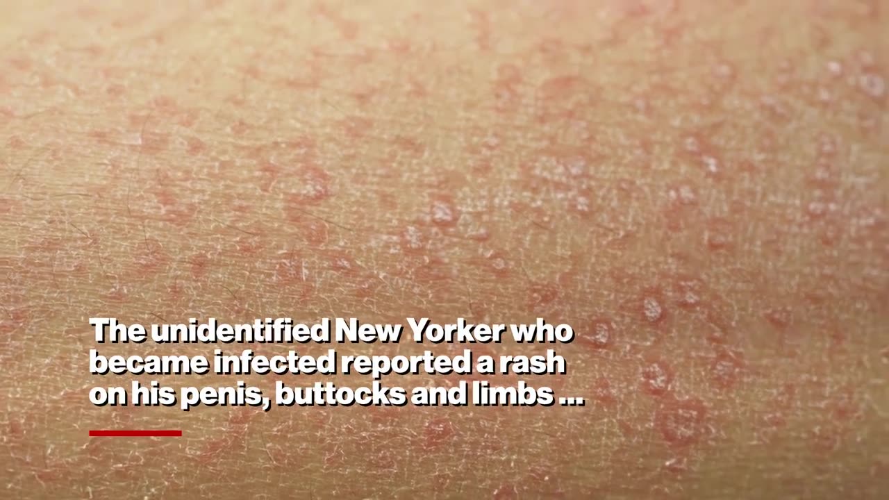 New STI Detected in NYC - Form of Ring worms